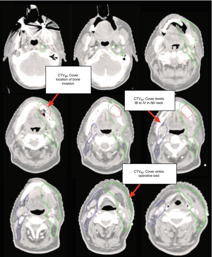 Cavity Cancer | Radiology Key
