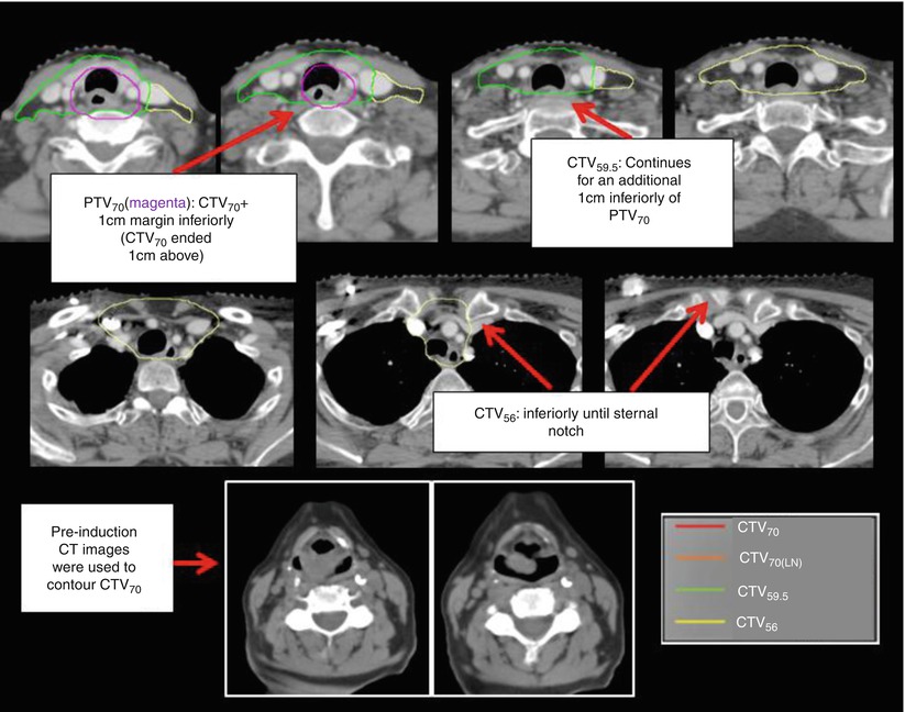 Carcinoma | Radiology Key