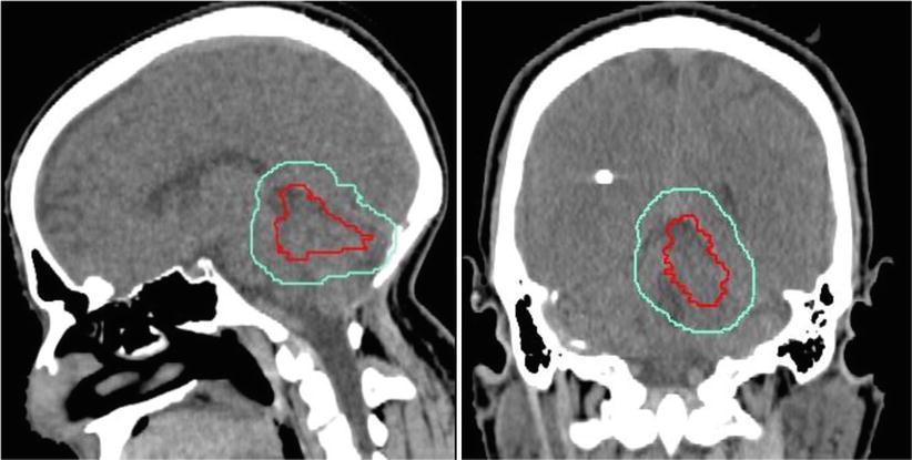 Glioma | Radiology Key