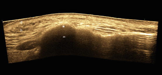 Dermatologic Ultrasound | Radiology Key