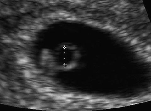 Threshold, Discriminatory Zone, and “The New Rules” | Radiology Key