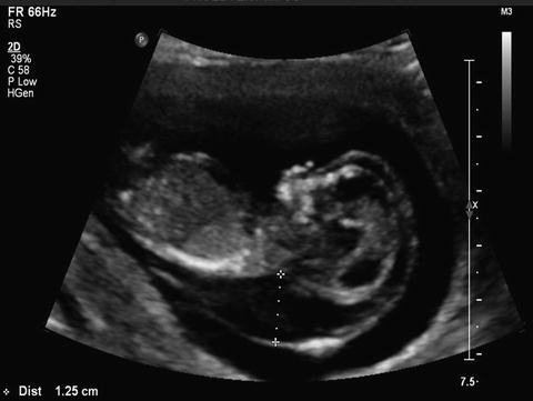 First-Trimester Embryology: An Overview | Radiology Key