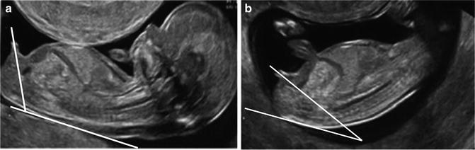 Normal First Trimester of Pregnancy | Radiology Key