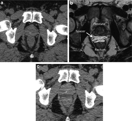 Stereotactic Body Radiation Therapy (SBRT) or Alternative Fractionation ...