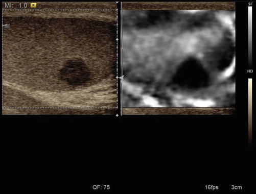 Testis | Radiology Key