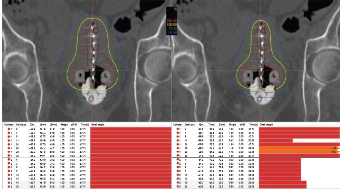 Gynecologic Brachytherapy | Radiology Key