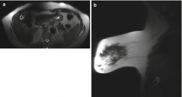 Benign Findings | Radiology Key