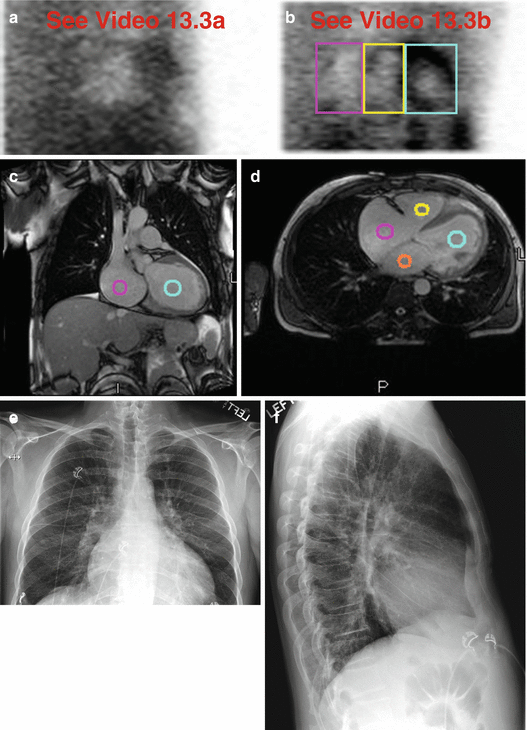 Right Atrium and Right Ventricle | Radiology Key