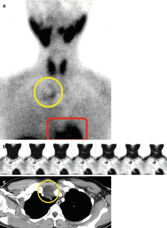 Parathyroid Glands | Radiology Key
