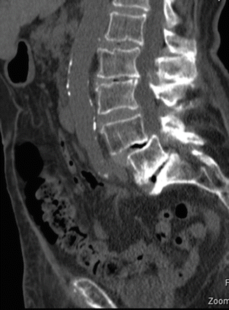 Findings on Abdominal CT | Radiology Key