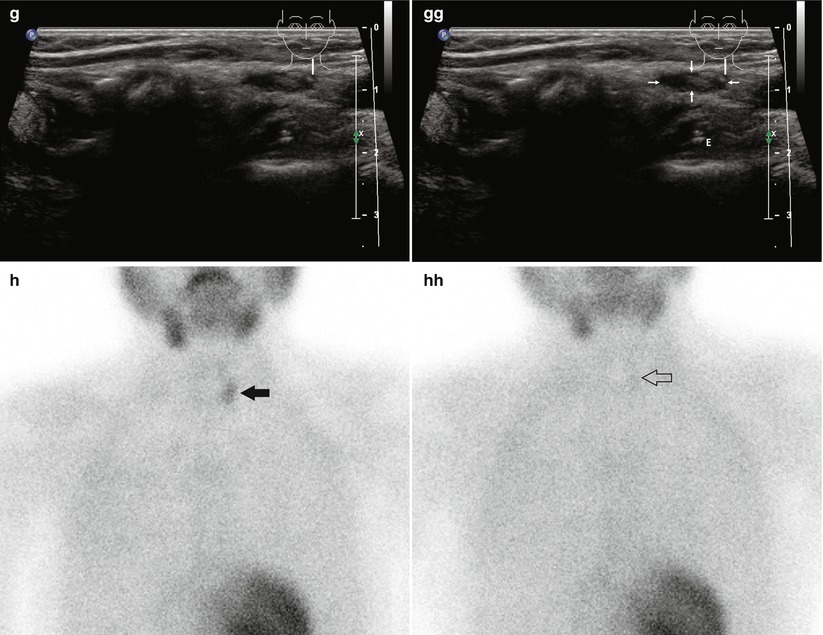 Percutaneous Ethanol Injection Therapy | Radiology Key