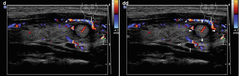 Solid Nodule | Radiology Key