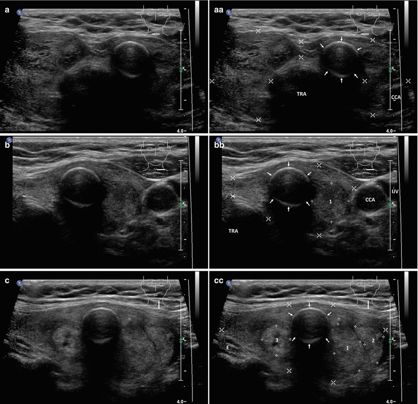 Complex Nodule Radiology Key