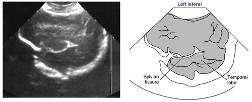 Neonatal Brain Scanning Protocol | Radiology Key