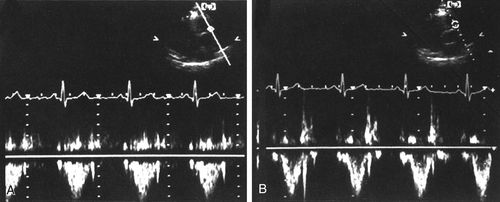 Adult Echocardiography Scanning Protocol | Radiology Key