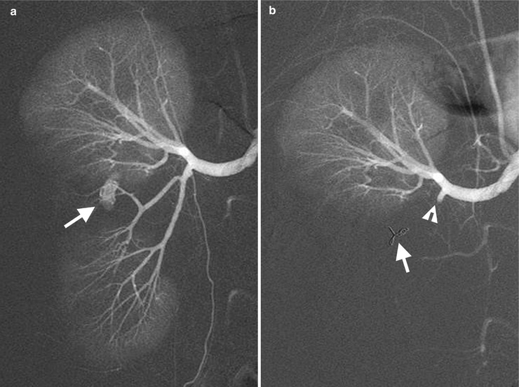Injury, Post-interventional Disease, and Blunt Trauma | Radiology Key