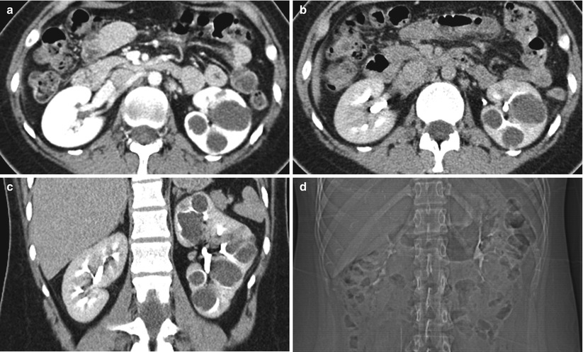 Renal Cystic Disease | Radiology Key