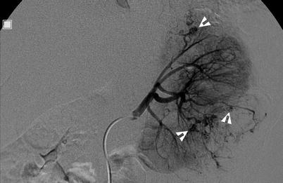 Vascular Diseases and Normal Variants | Radiology Key