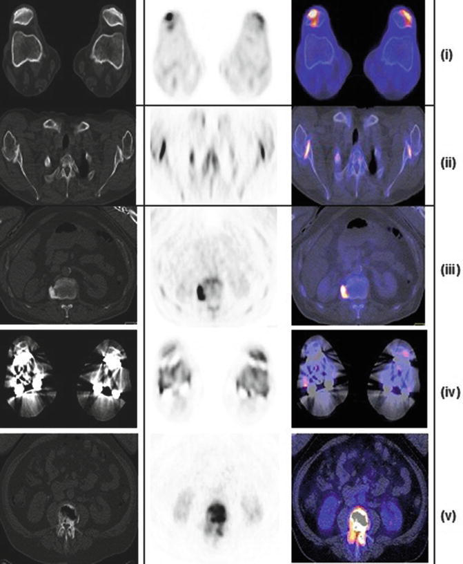 F-18 Fluoride Bone Scintigraphy | Radiology Key