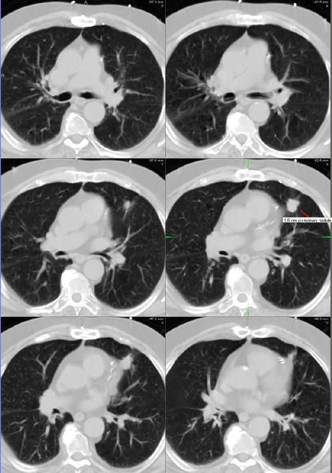 Myocardial Viability | Radiology Key