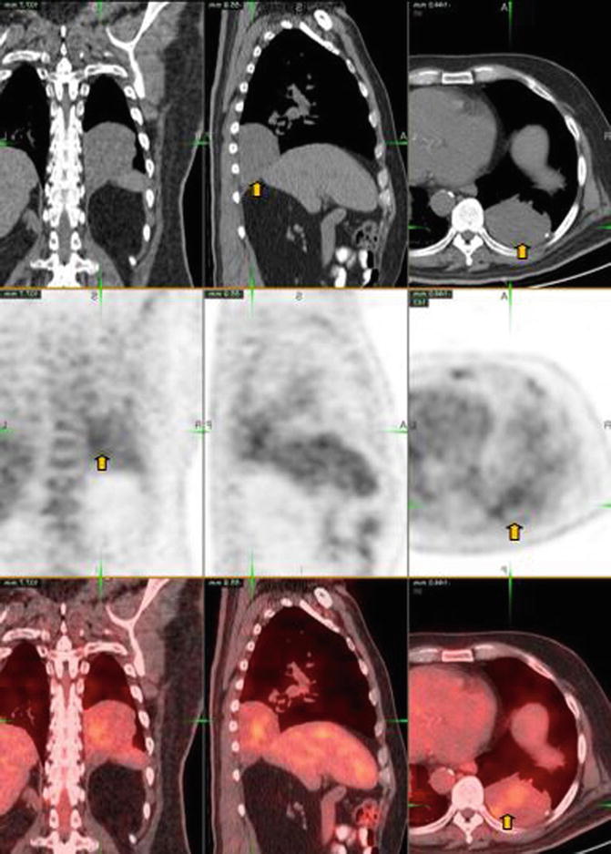 Lung Neoplasms | Radiology Key