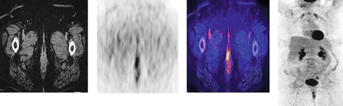 Gynecologic Neoplasms: Cervical, Ovarian, Vulvar, Uterine, and ...