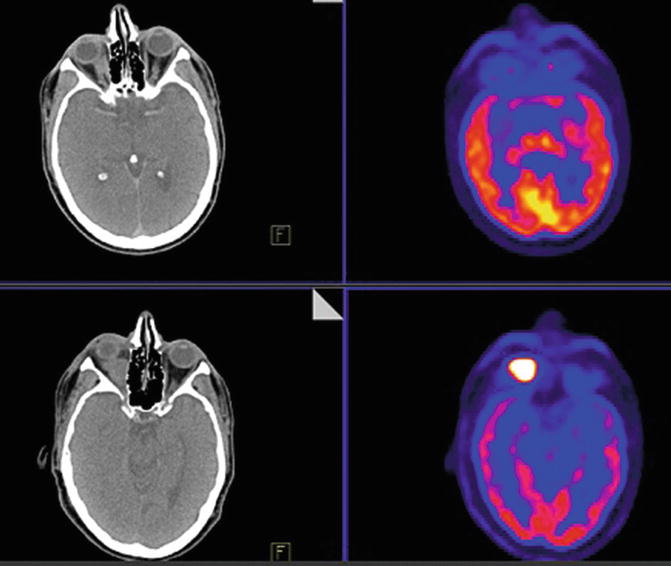 Lymphoma | Radiology Key