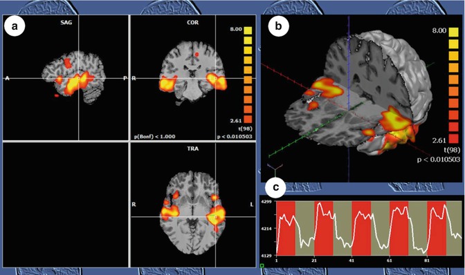 Functional MRI at 3.0 Tesla | Radiology Key