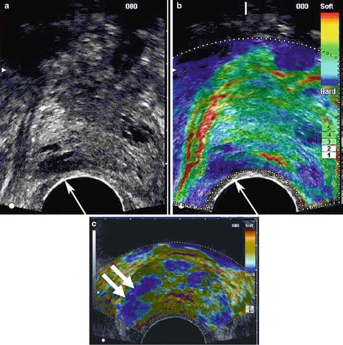 Penile Ultrasound | Radiology Key