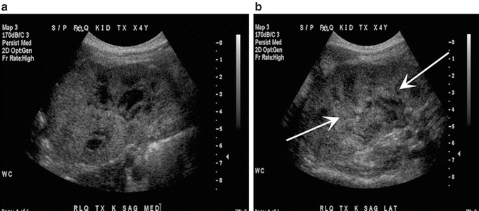 Application of Urologic Ultrasound in Pelvic and Transplant Kidneys ...