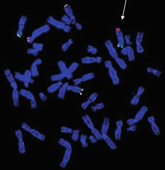Unilateral Agenesis of the Mandible (Agnathia) in a Fetus with 4p-/10q ...