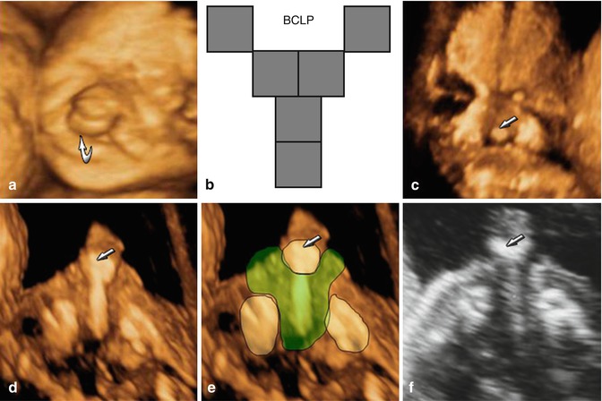 The Role of 2D/3D/4D Ultrasound in the Prenatal Assessment of Cleft Lip ...
