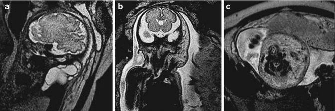 Prenatal Diagnosis of Orofacial and Neck Tumors | Radiology Key