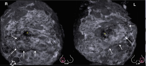 Clinical Application of ABVS for Breast Studies | Radiology Key