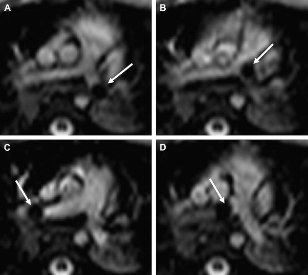 MR Imaging-Guided Cardiovascular Interventions in Young Children ...
