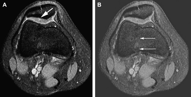MRI Appearance of Normal Articular Cartilage | Radiology Key