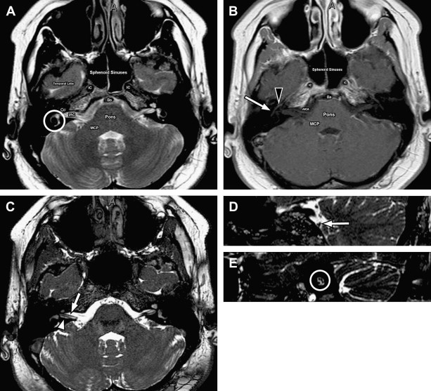 Skull Base, Orbits, Temporal Bone, and Cranial Nerves: Anatomy on MR ...