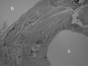 The Rotator Interval and Long Head Biceps Tendon: Anatomy, Function ...