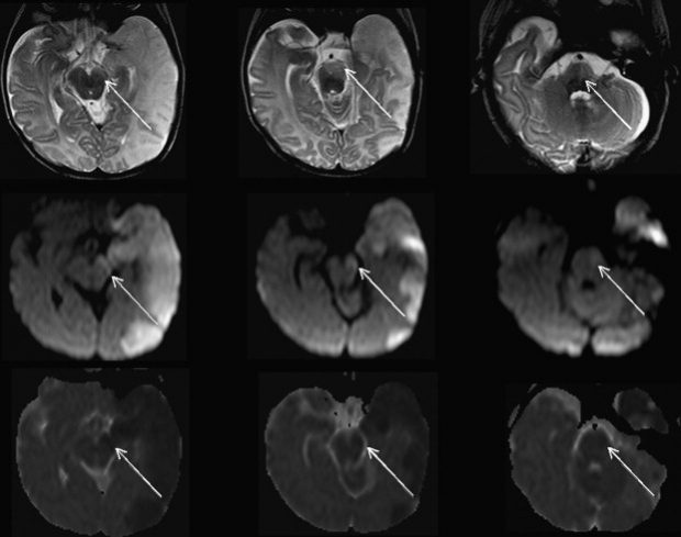 Neonates with Seizures: What to Consider, How to Image | Radiology Key