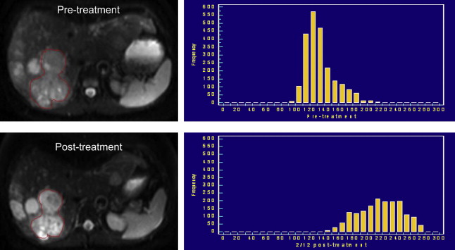 Perfusion Imaging in Liver MRI | Radiology Key