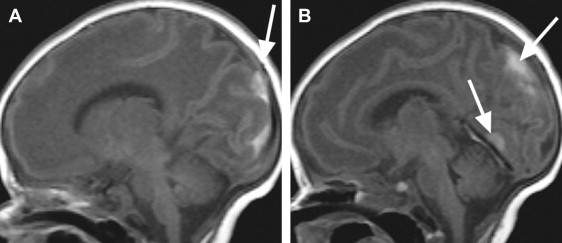 MR Imaging in Inflicted Brain Injury | Radiology Key
