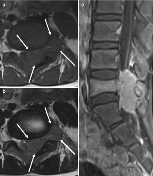 Top 3 Spinal Tumors of Each Compartment | Radiology Key