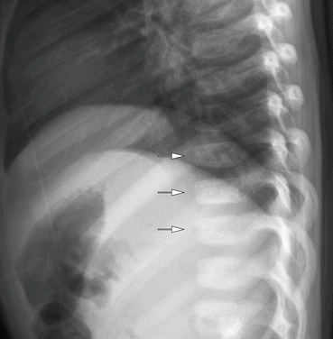 The Spine | Radiology Key