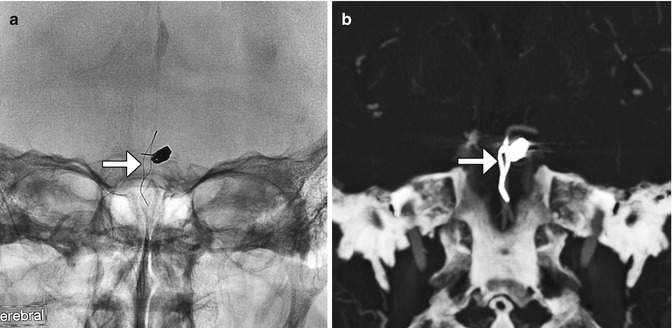 Imaging of Vascular and Endovascular Surgery | Radiology Key