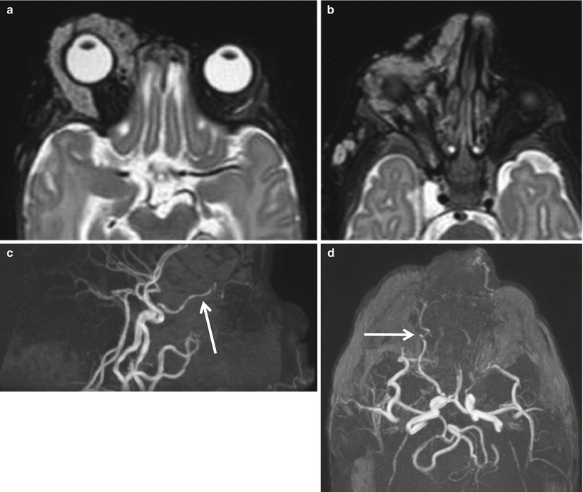 Malformations of the Eye and Orbit | Radiology Key