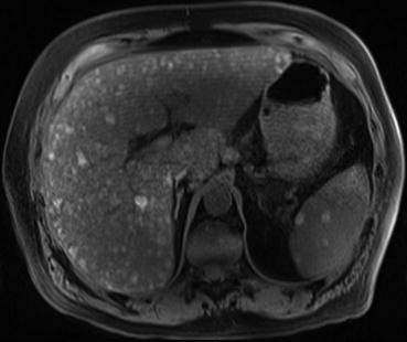 Radiological Imaging in Melanoma | Radiology Key