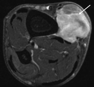 WHO Classification of Soft Tissue Tumors | Radiology Key