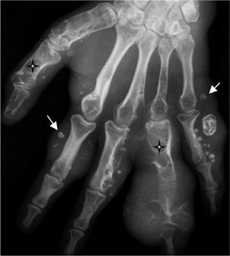 Vascular Tumors | Radiology Key