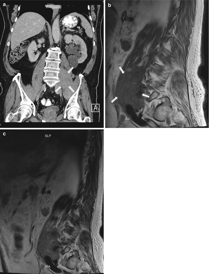 Soft Tissue Lymphoma | Radiology Key