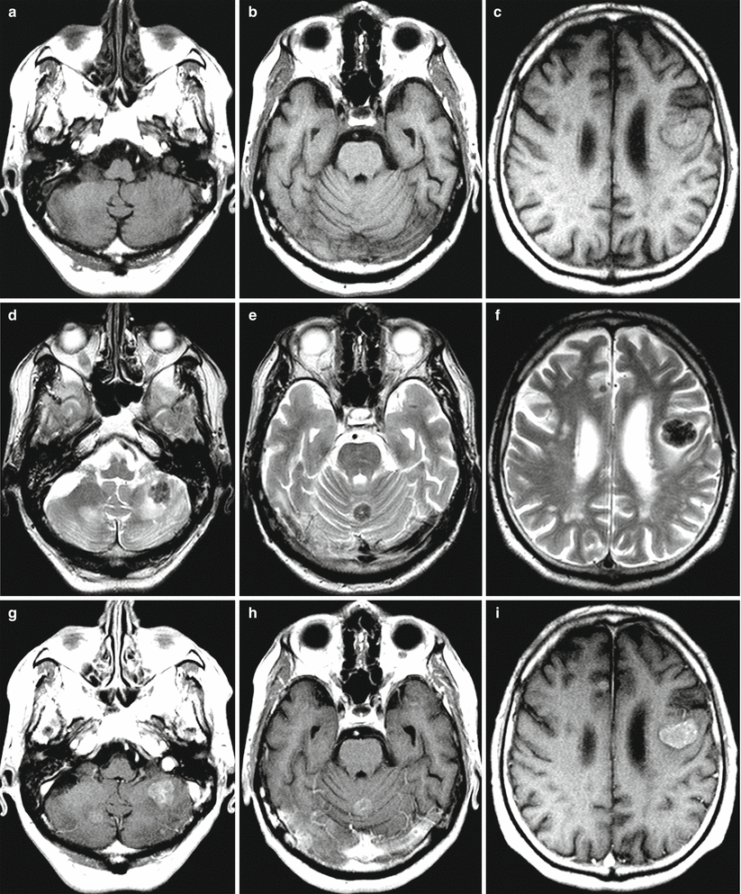 Rare Forms of Cancer with Metastases in the Brain | Radiology Key